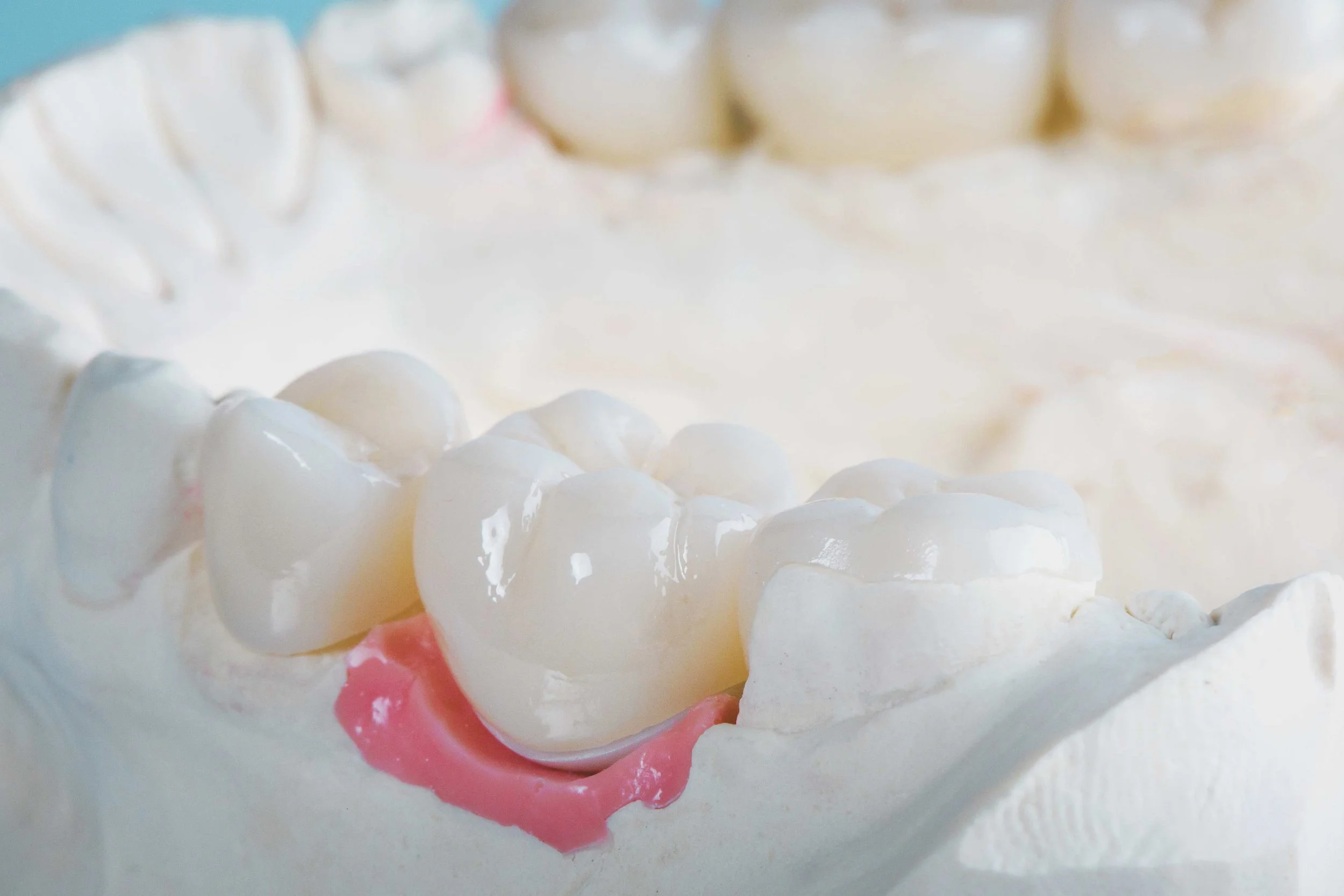 Inlays, Onlays & Crowns Explained