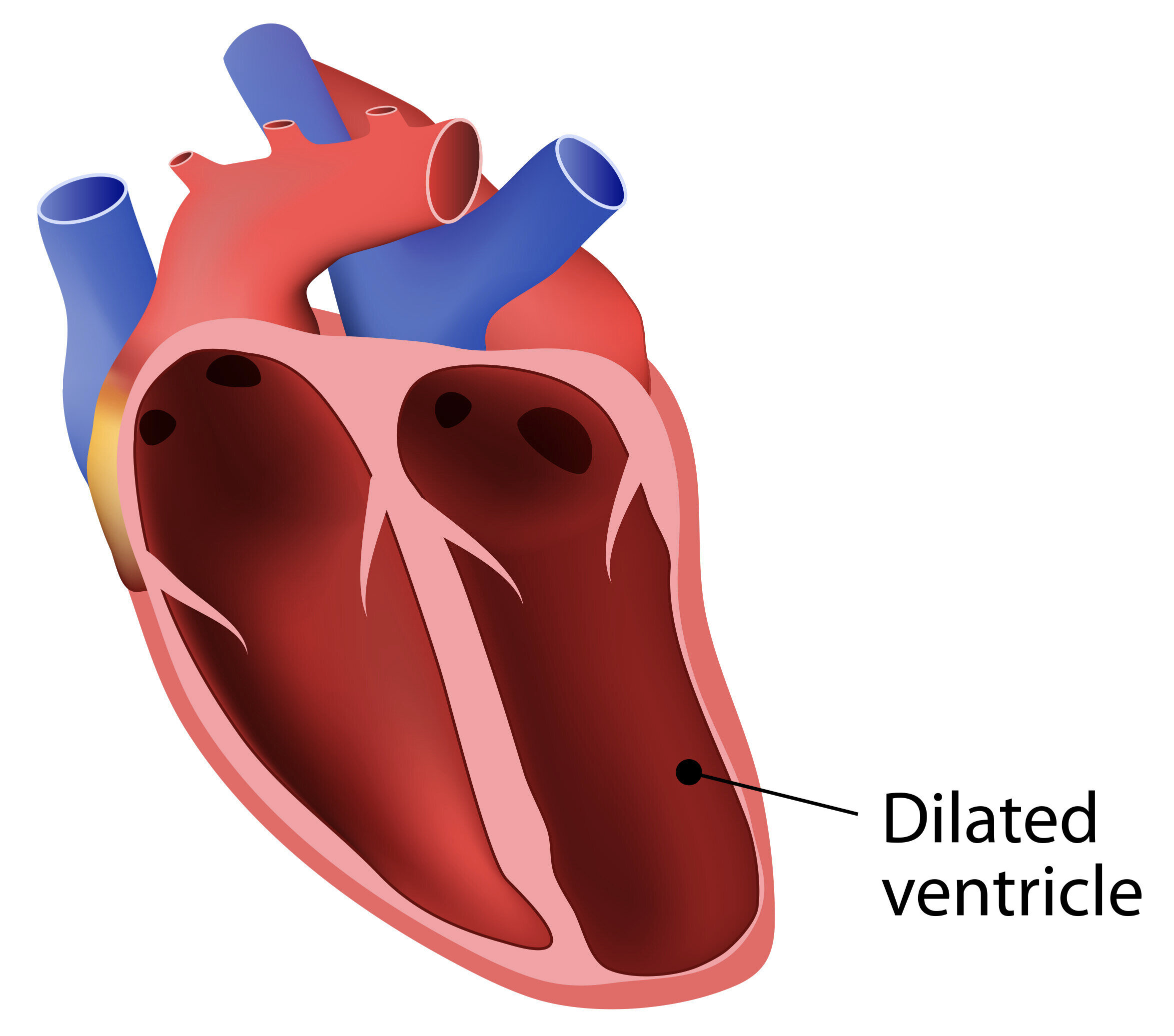 Heart Failure — Dr Young Yu · Cardiologist · Sydney