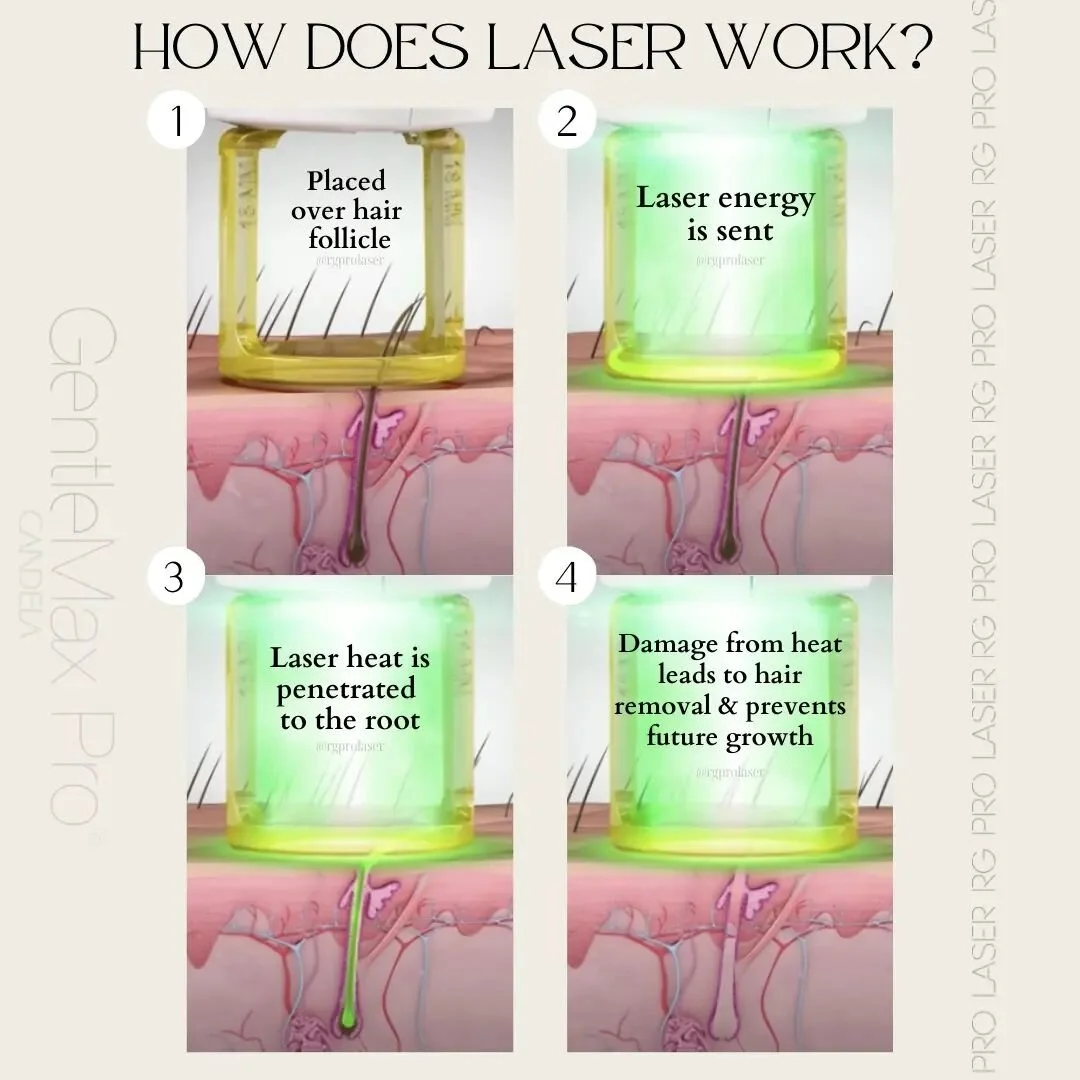 RG PRO LASER