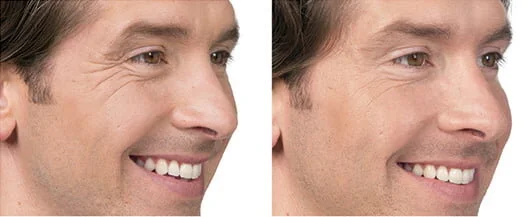 Botox Before And After Men