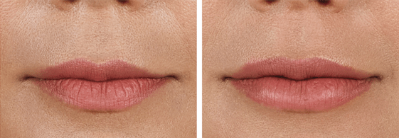 Lip Fillers - Lip Flip - Exton, Philadelphia, King of Prussia