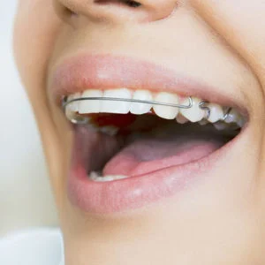 What Orthodontic Treatments Can Correct an Underbite in Children?