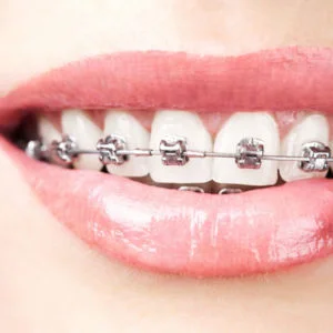 How do Braces Really Work the Science Behind Orthodontics | Chester ...
