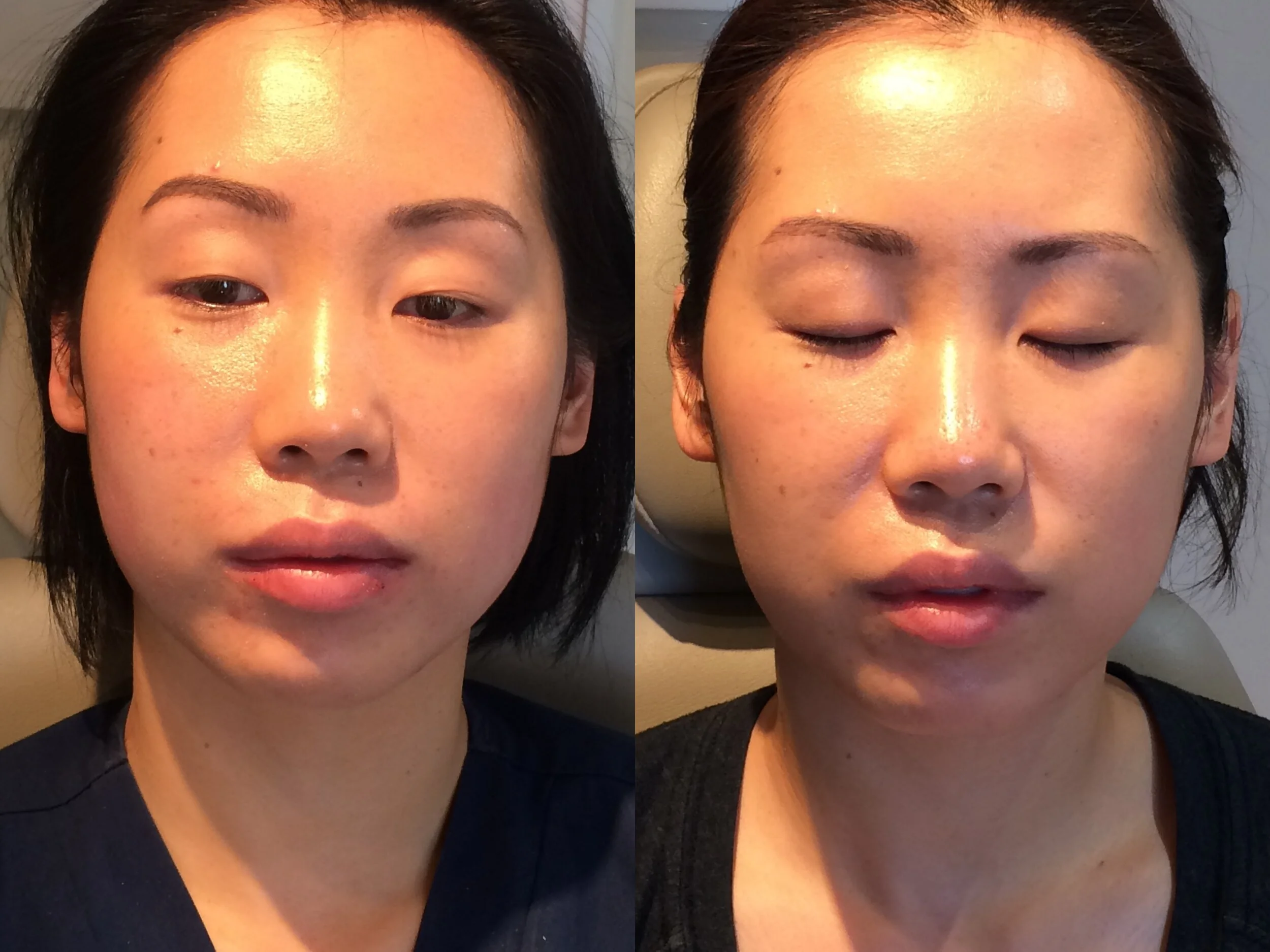 BOTOX® — Jessica Friedman RN, BSN