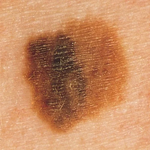 How To Spot Skin Cancer Assured Healthcare Staffing how-to-spot-skin-cancer-assured-healthcare-staffing