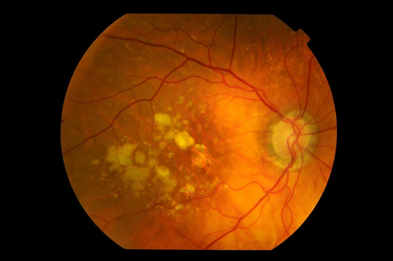 Macular Degeneration STRATHFIELD RETINA CLINIC Macular Degeneration STRATHFIELD RETINA CLINIC