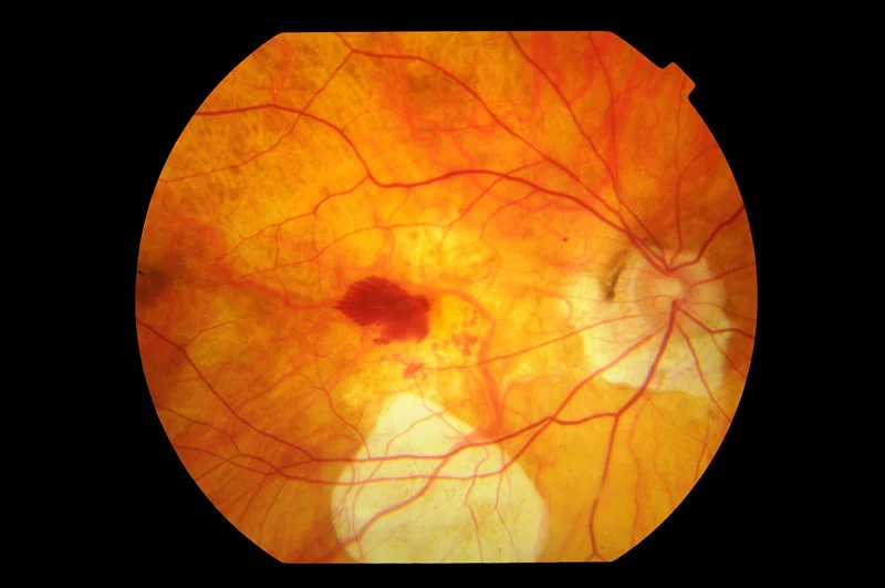 Myopic Degeneration STRATHFIELD RETINA CLINIC