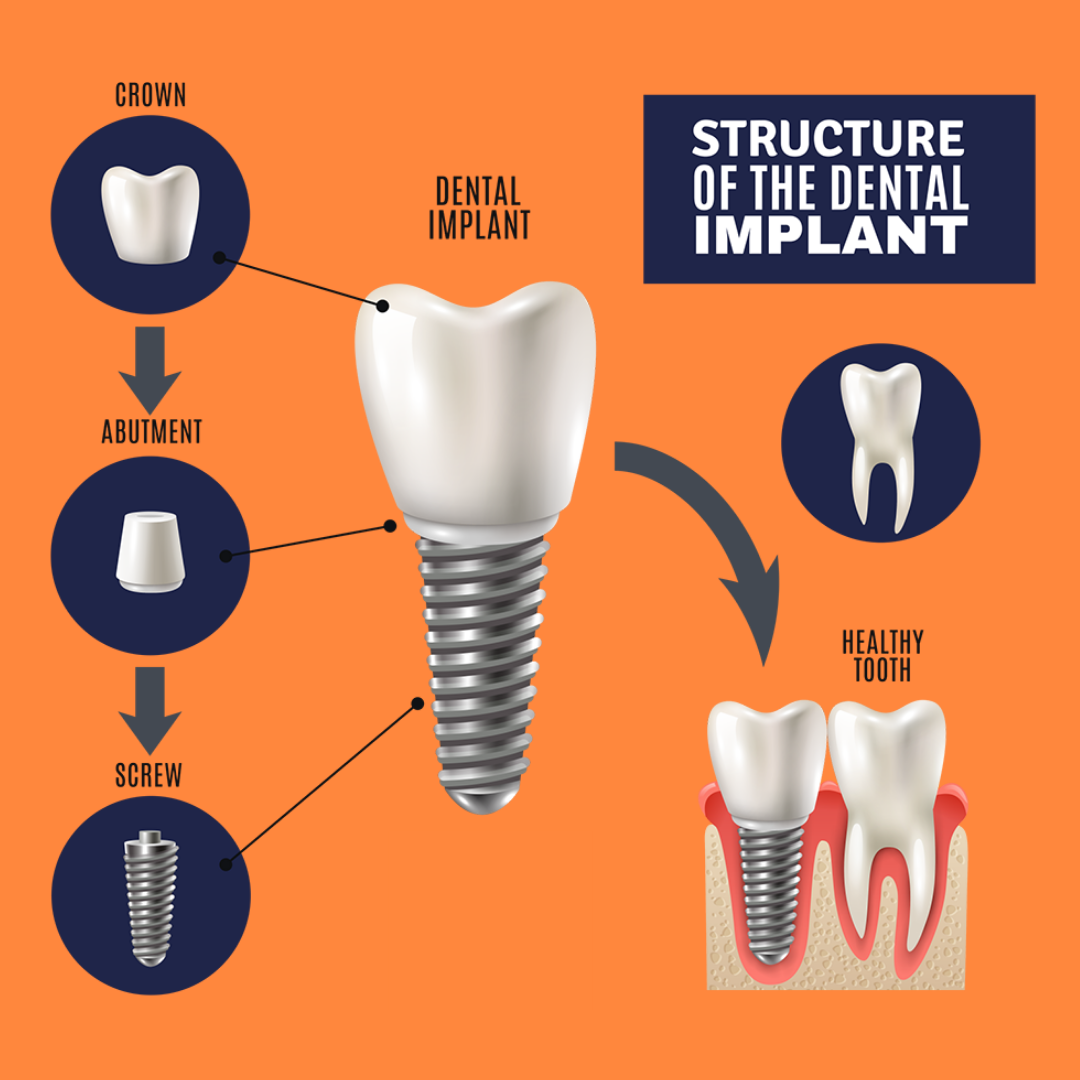 Teeth On Implants® — Your Tamworth Dentist
