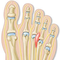 Treatment for Morton's Neuroma — Fitzroy Foot and Ankle Clinic