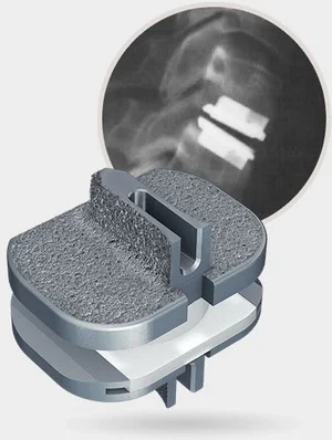 Cervical Disc Replacement - prodisc C Implant — Michigan Spine Clinic