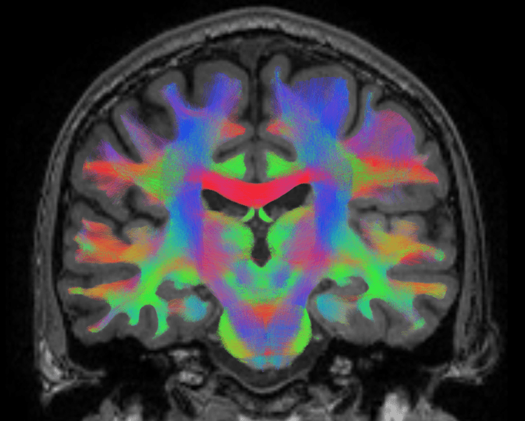 Build a Better Brain: How to Grow Grey and White Matter — Dr. Greg ...