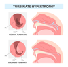 Turbinate Reduction | doctorlansford.com