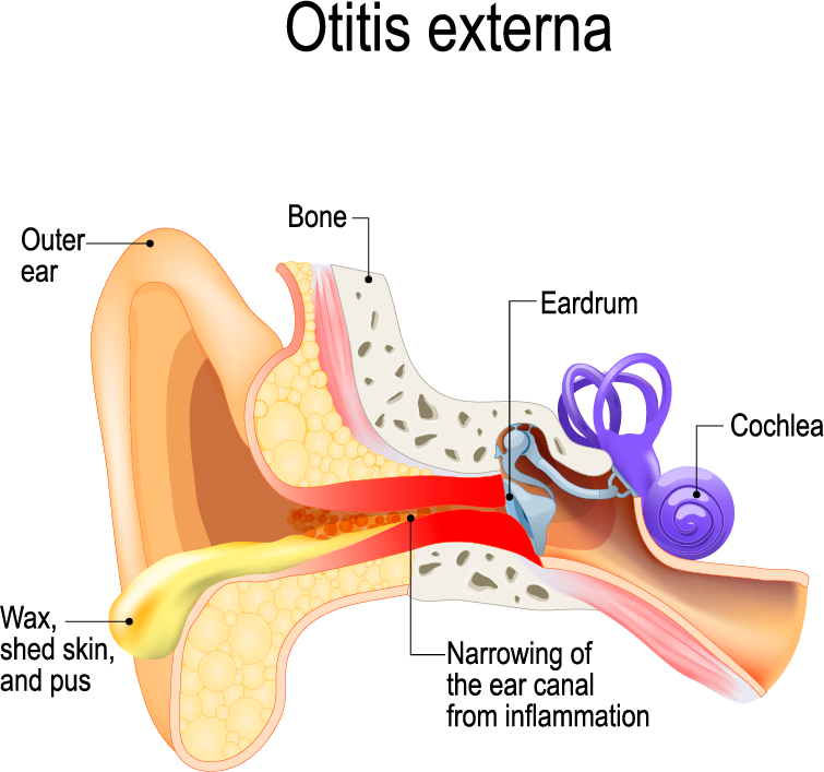 Treatments for Fungal Otitis Externa | doctorlansford.com