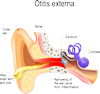 Fungal Otitis Externa (Fungal Infection of the Ear Canal ...