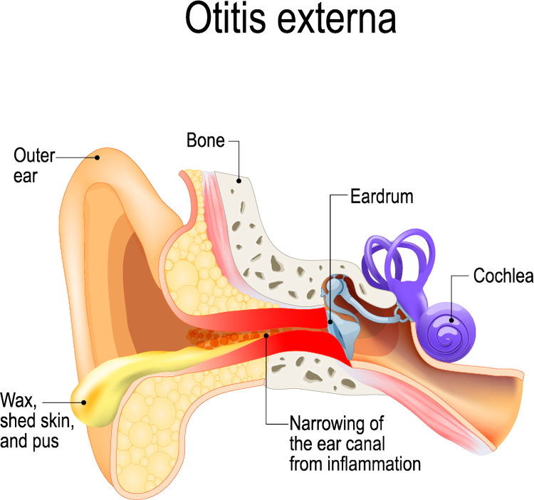 Treatments for Fungal Otitis Externa | doctorlansford.com