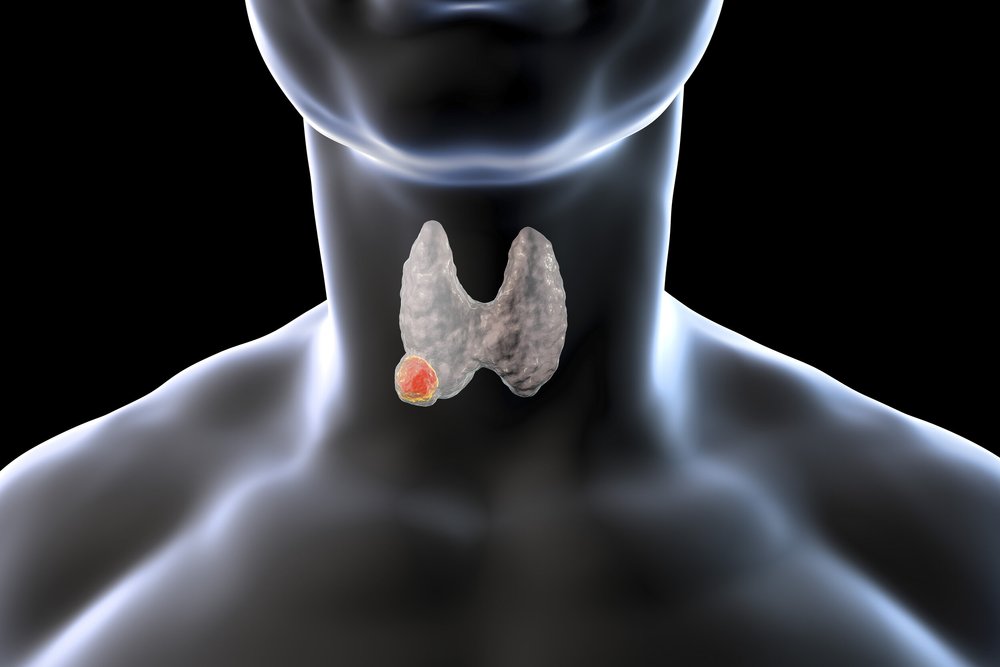 Thyroid Nodule | doctorlansford.com
