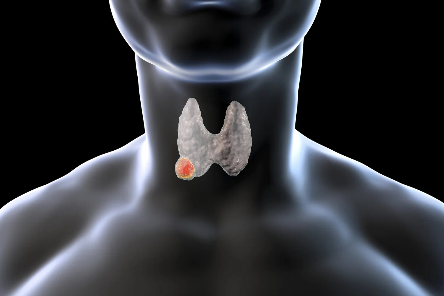 Thyroid Nodule | doctorlansford.com