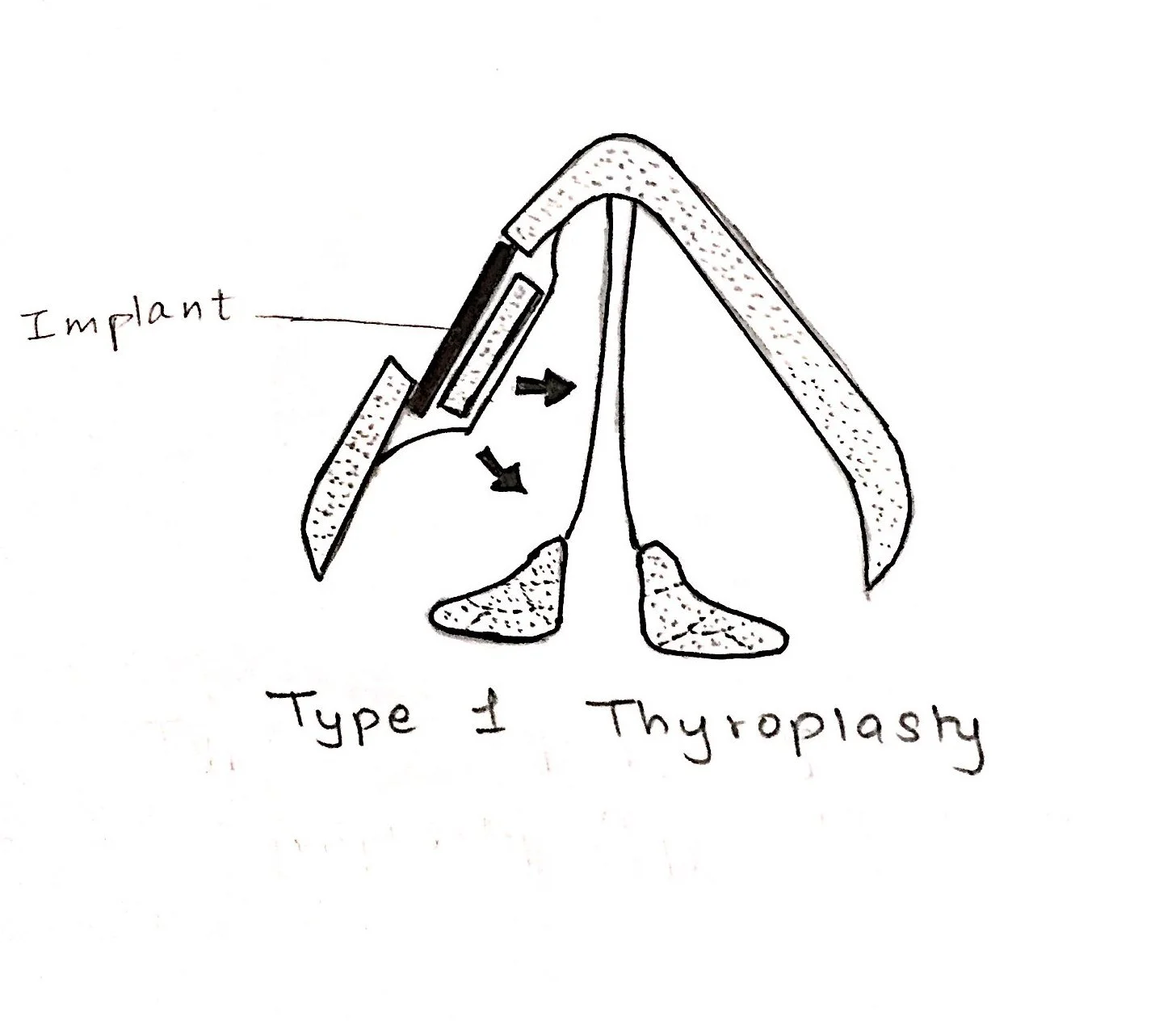Treatments for Conditions of the Voice Box (Larynx)