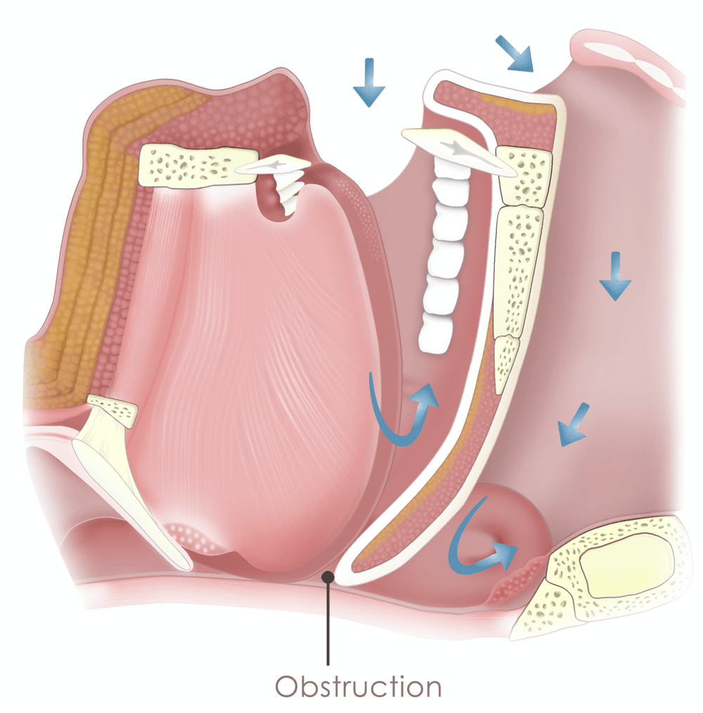 Loss of Airway | doctorlansford.com