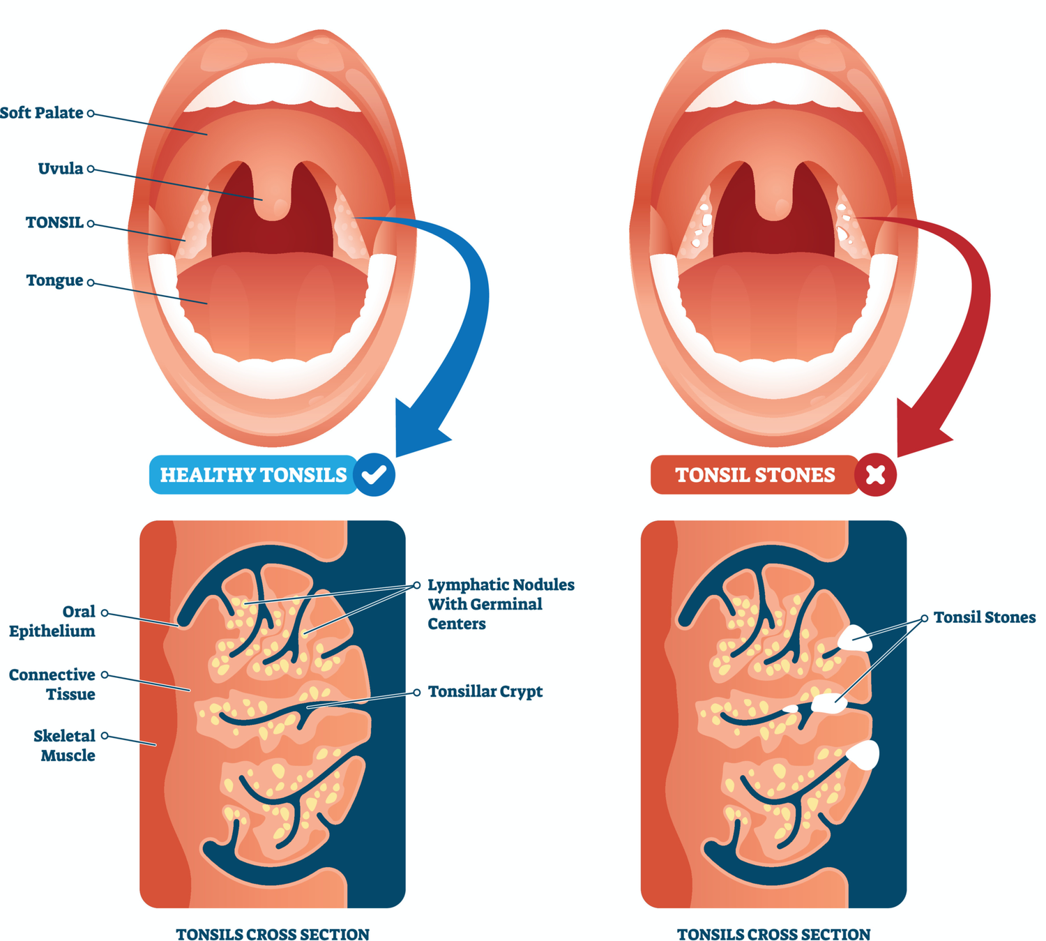 Tonsil and/or adenoid problems | doctorlansford.com