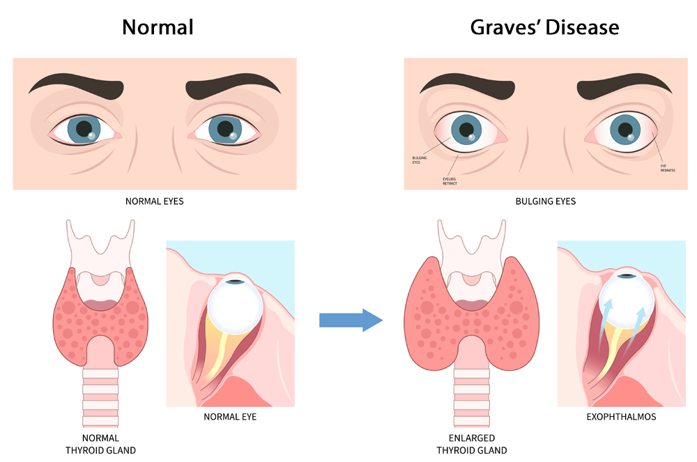 graves-disease-doctorlansford