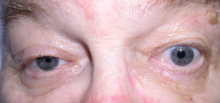 Horner's Syndrome | doctorlansford.com