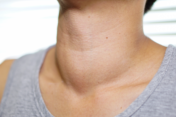 Thyroid Goiter | doctorlansford.com