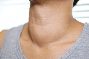 Thyroid Goiter | doctorlansford.com