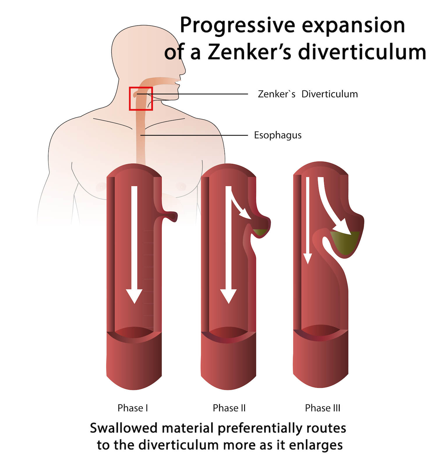 Zenker's Diverticulum | doctorlansford.com
