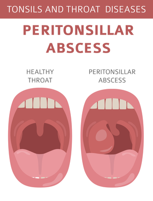 Tonsil Abscess and Peritonsillar Abscess | doctorlansford.com