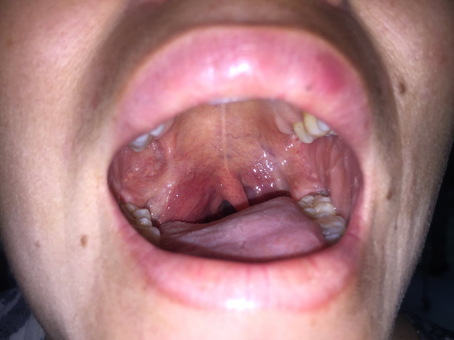 Tonsil Abscess And Peritonsillar Abscess