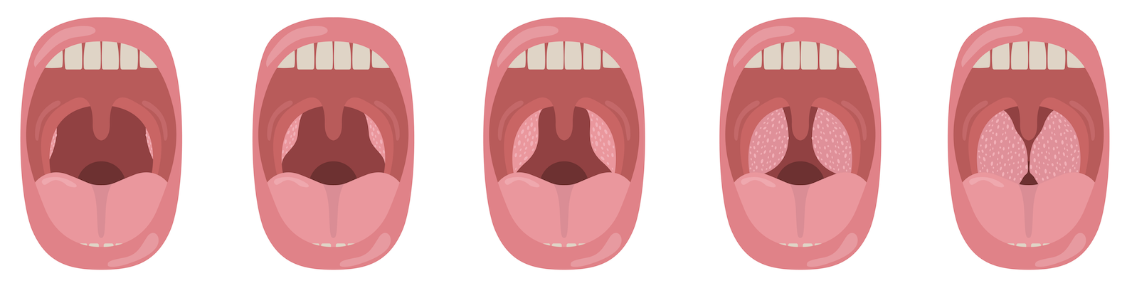 Tonsil and/or adenoid problems | doctorlansford.com