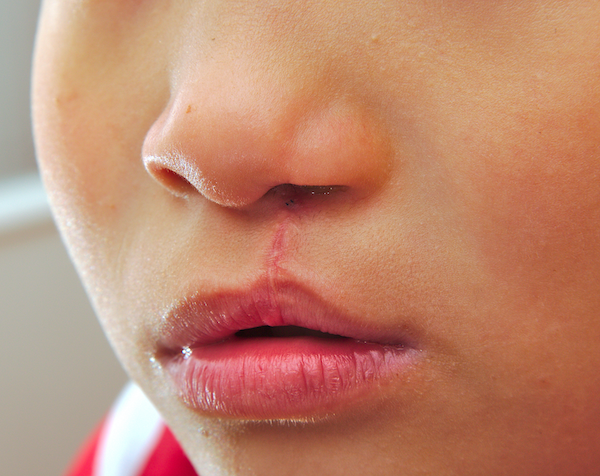 Conditions Affecting the Shape of the Nose | doctorlansford.com
