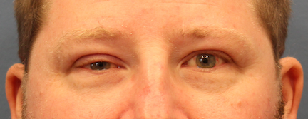 Horner's Syndrome | doctorlansford.com