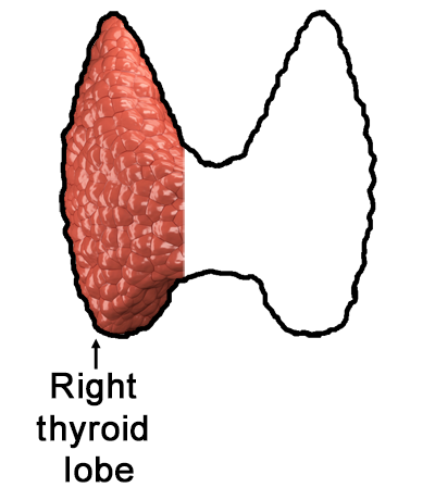 Extent of Thyroid Surgery (total thyroidectomy, partial thyroidectomy, removal of lymph nodes)