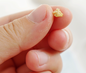 Tonsil and/or adenoid problems | doctorlansford.com