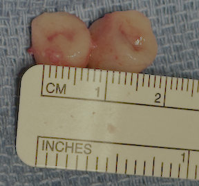 Lymph node | doctorlansford.com