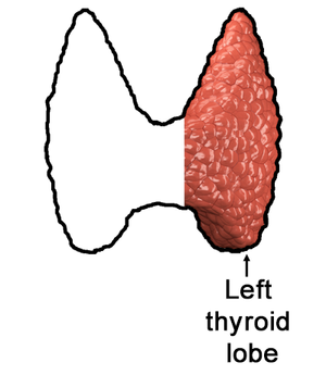 Extent of Thyroid Surgery (total thyroidectomy, partial thyroidectomy ...