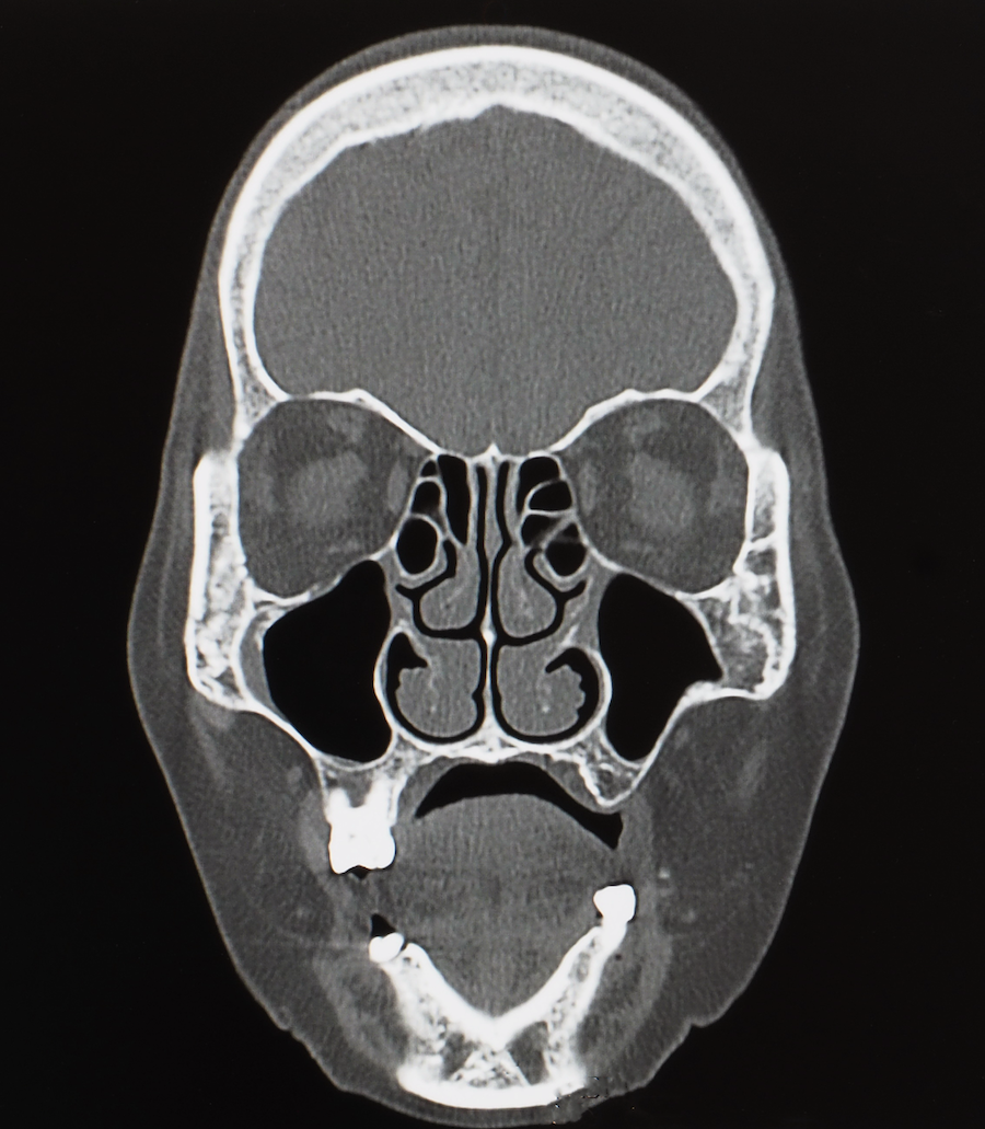 Intracranial (Dura, CSF, Brain) Injury and Sinus Surgery ...