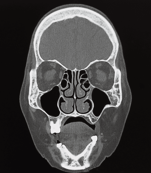 Intracranial (Dura, CSF, Brain) Injury and Sinus Surgery ...