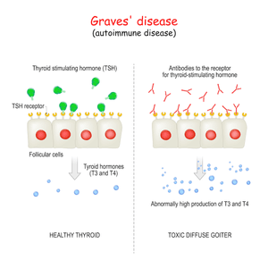 Graves' disease | doctorlansford.com