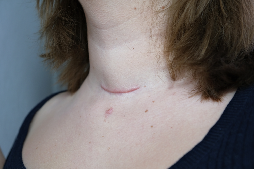 Thyroidectomy | doctorlansford.com