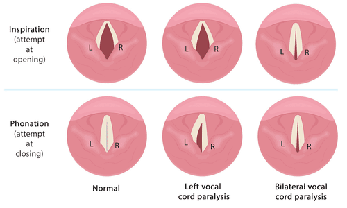 Laryngeal Nerve Dysfunction (Recurrent and Superior Laryngeal Nerves ...