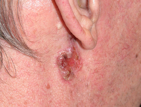 Basal Cell Carcinoma | doctorlansford.com