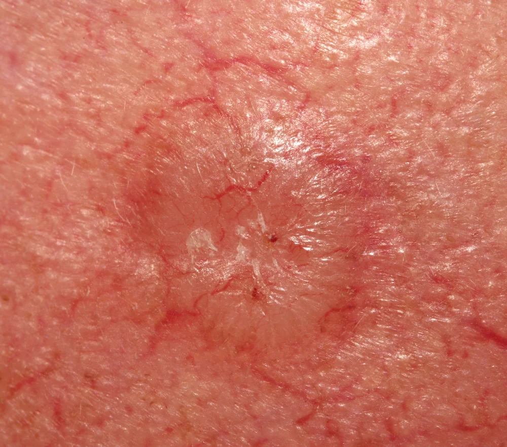 Basal Cell Carcinoma | doctorlansford.com