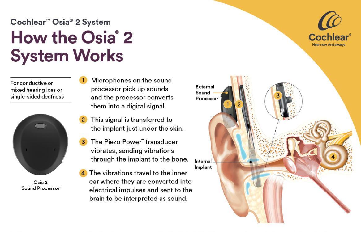 Osia bone conduction hearing implant | doctorlansford.com