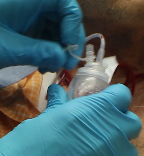 Care technique: JP drain after surgery | doctorlansford.com