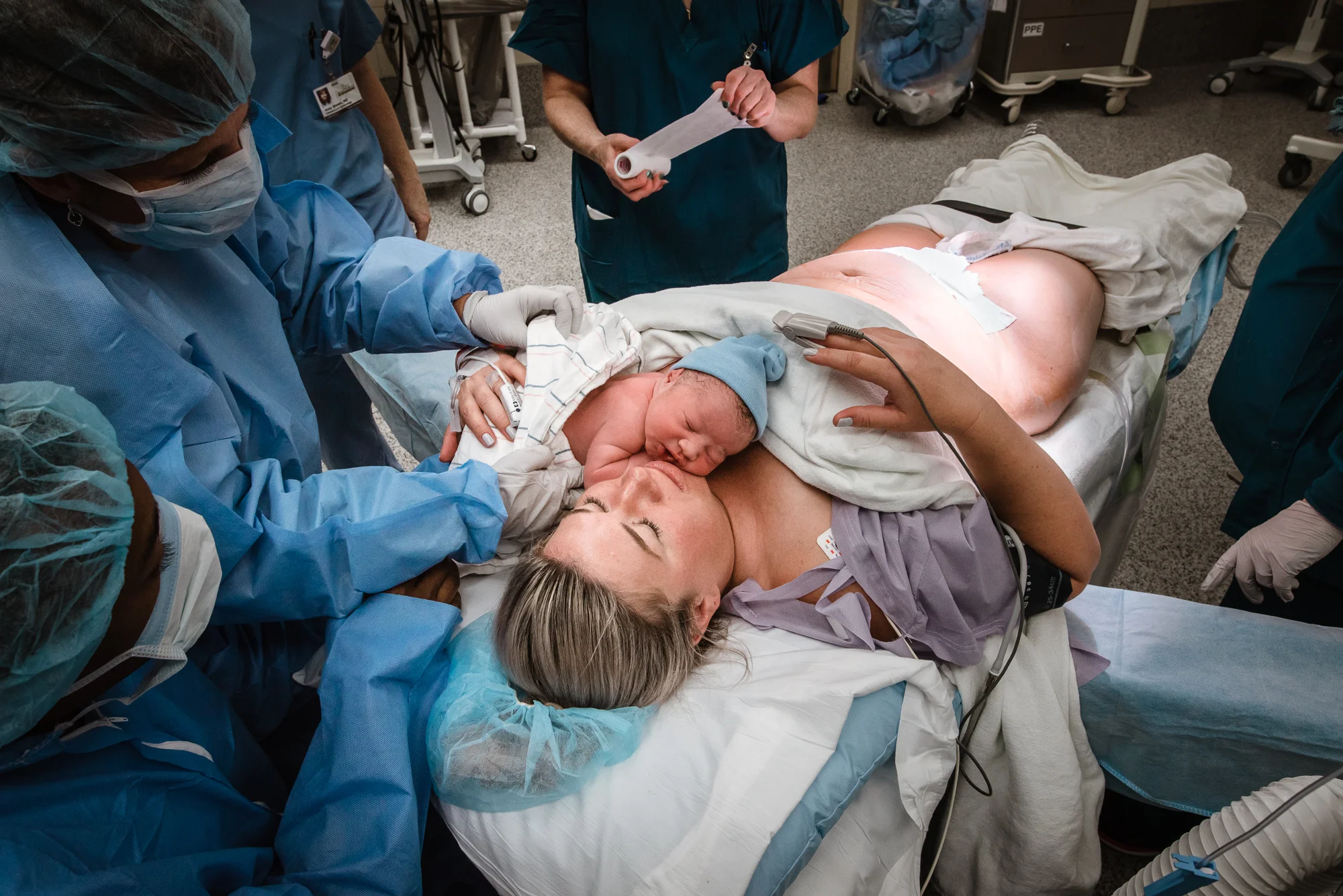 Breech Cesarean