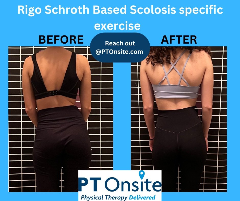Scoliosis Exercises Before And After