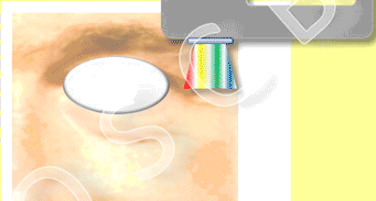 MGD - IPL Intense Pulsed Light Therapy — EyeCare